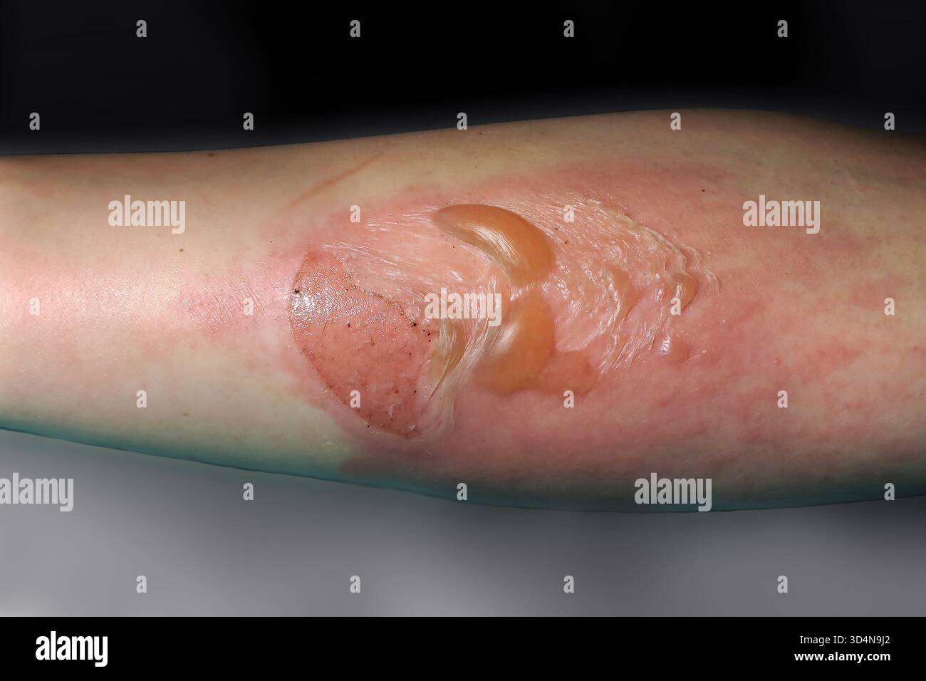 Blister of the forearm in a 24-year-old woman, burn from boiling water ...