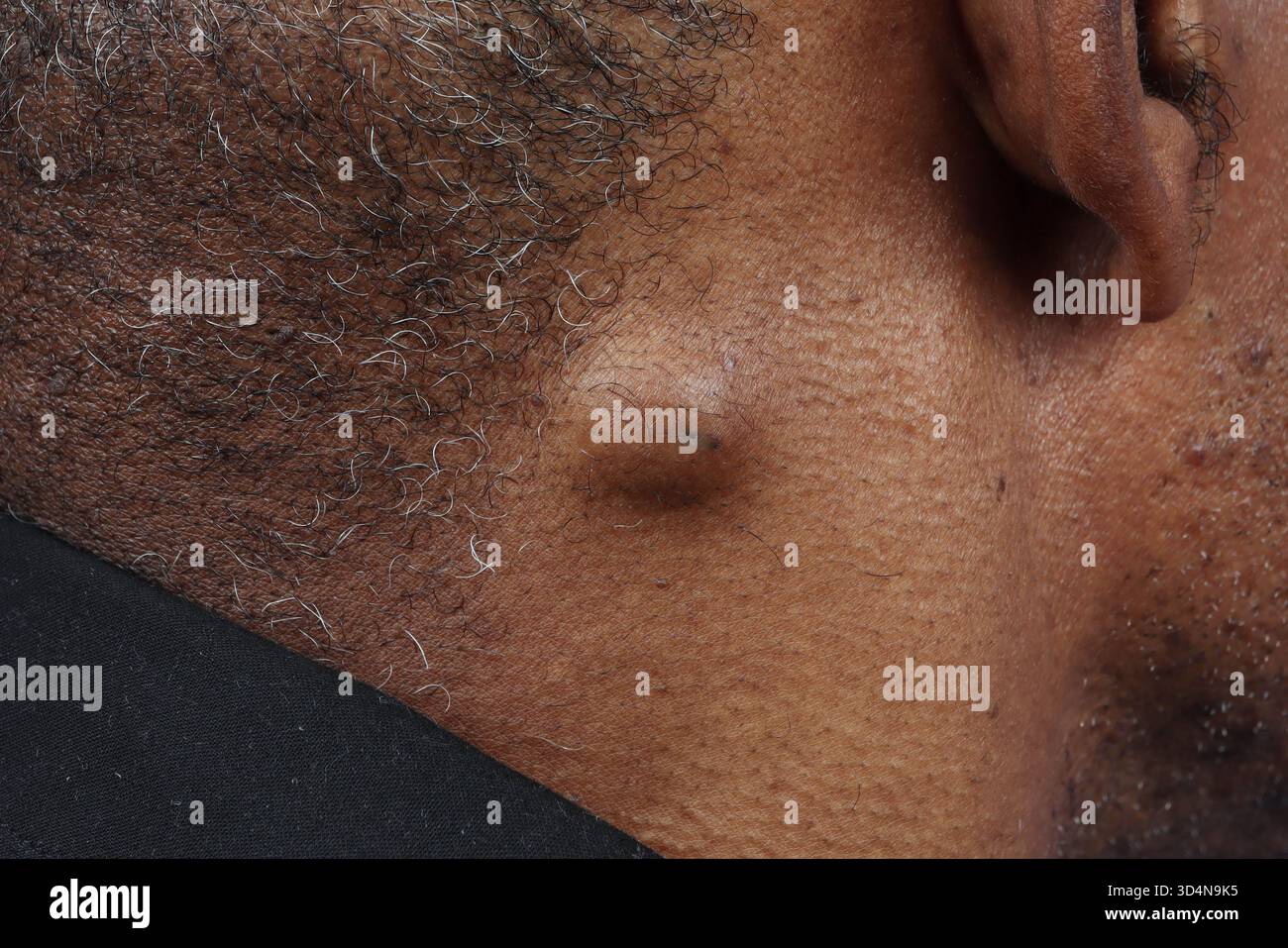 Cervical sebaceous cyst in a 63-year-old man Stock Photo - Alamy