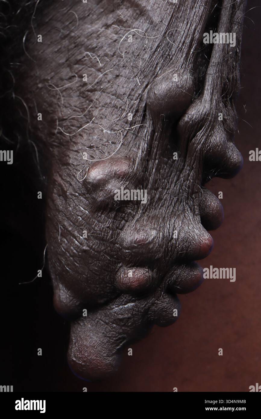 Scrotal cysts that had been developing for seven years in a 54-year-old ...