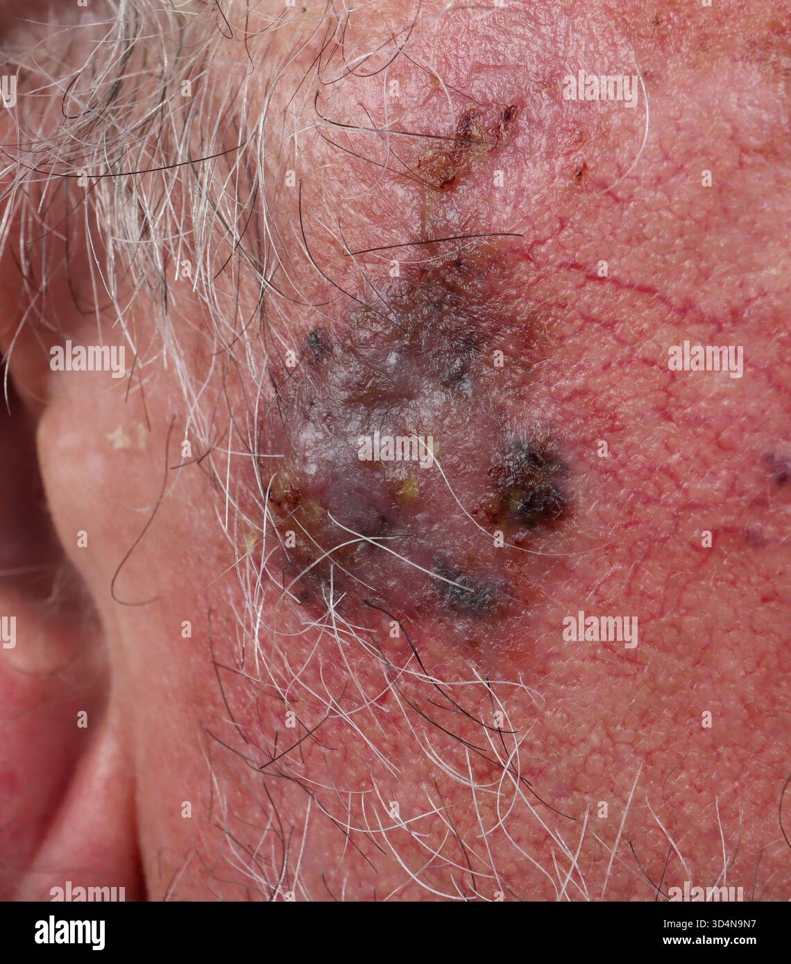 Pre-tragic SSM melanoma, Clark level 4, 2.1mm thick according to ...