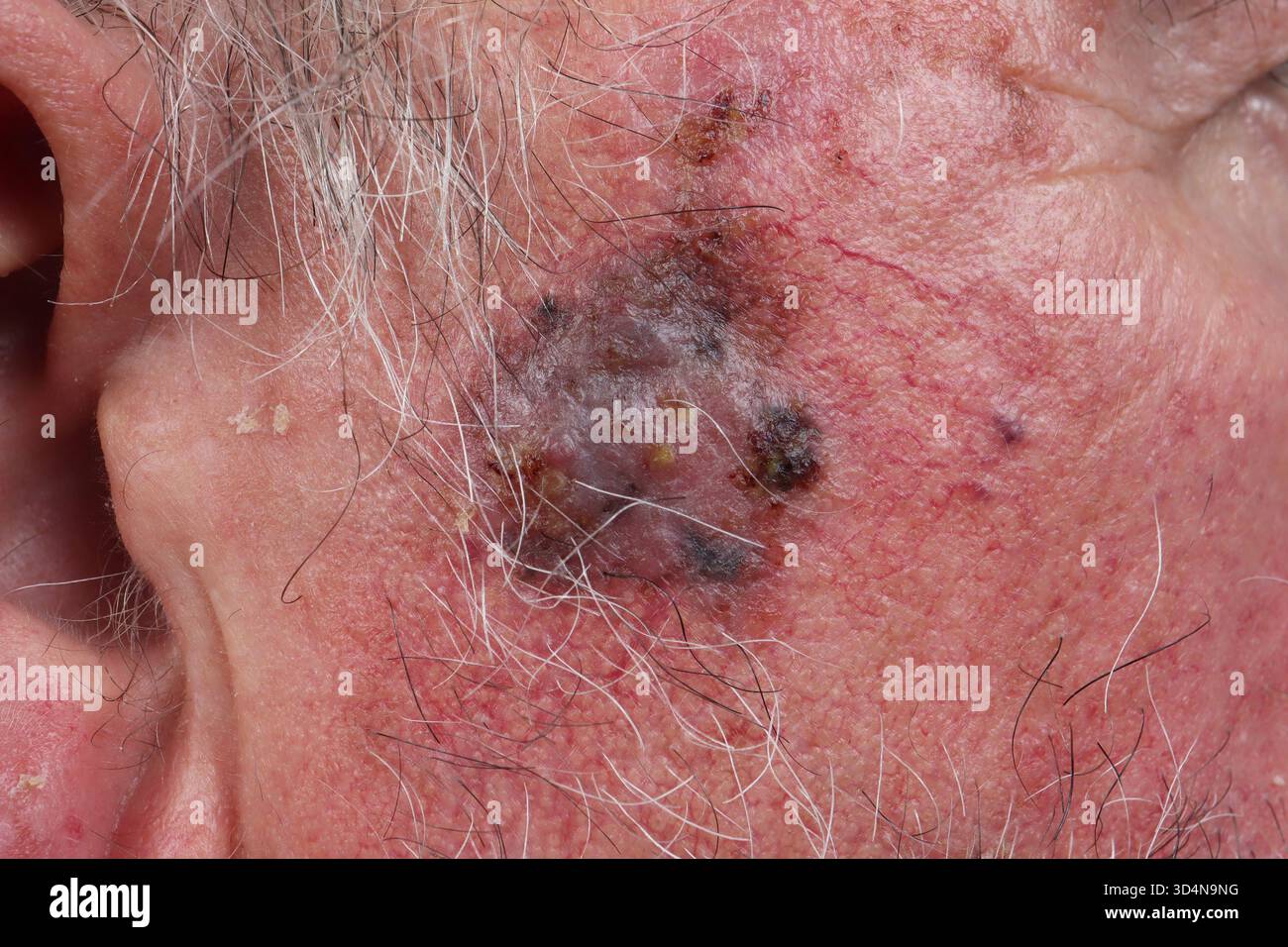 Pre-tragic SSM melanoma, Clark level 4, 2.1mm thick according to ...