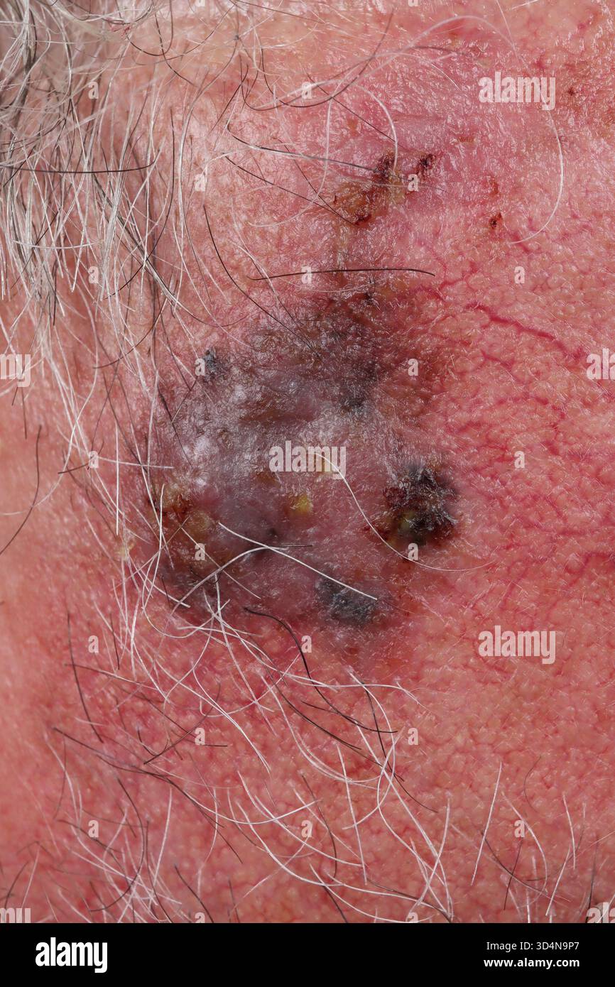 Pre-tragic SSM melanoma, Clark level 4, 2.1mm thick according to ...