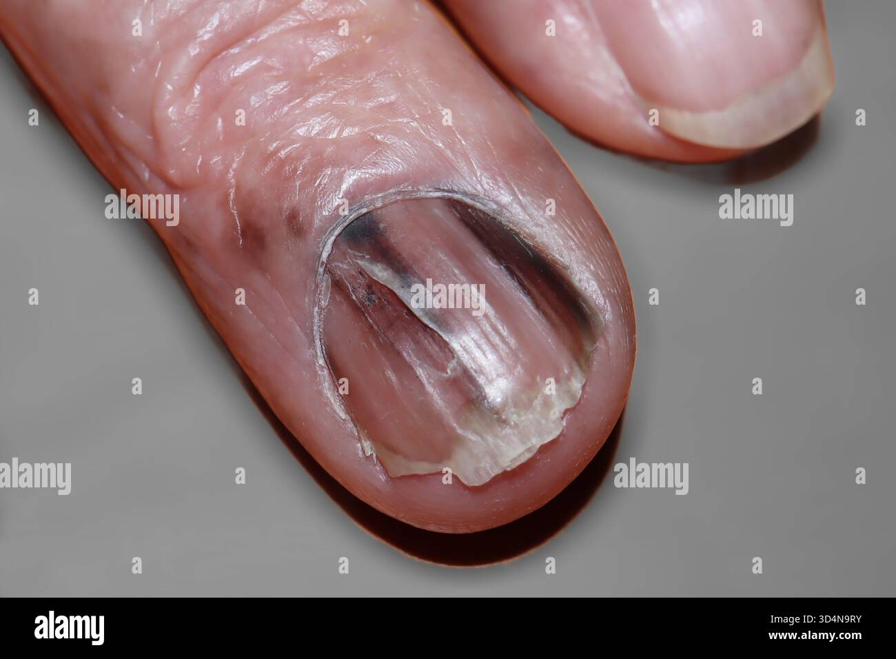 Nail melanoma of the 3rd finger, in an 88-year-old woman Stock Photo ...