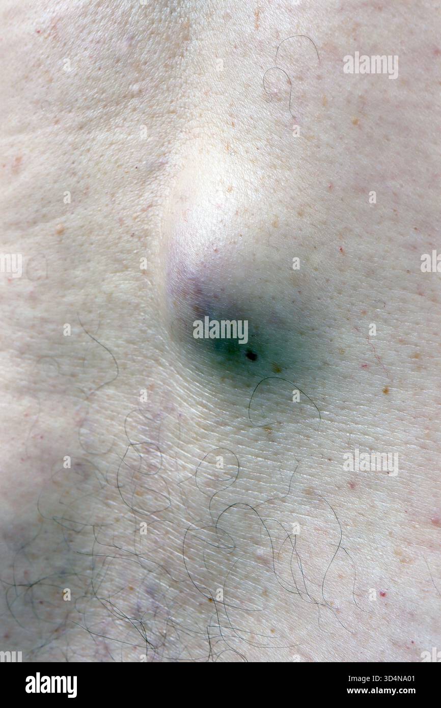 Sebaceous cyst of the back in a 71-year-old man Stock Photo - Alamy