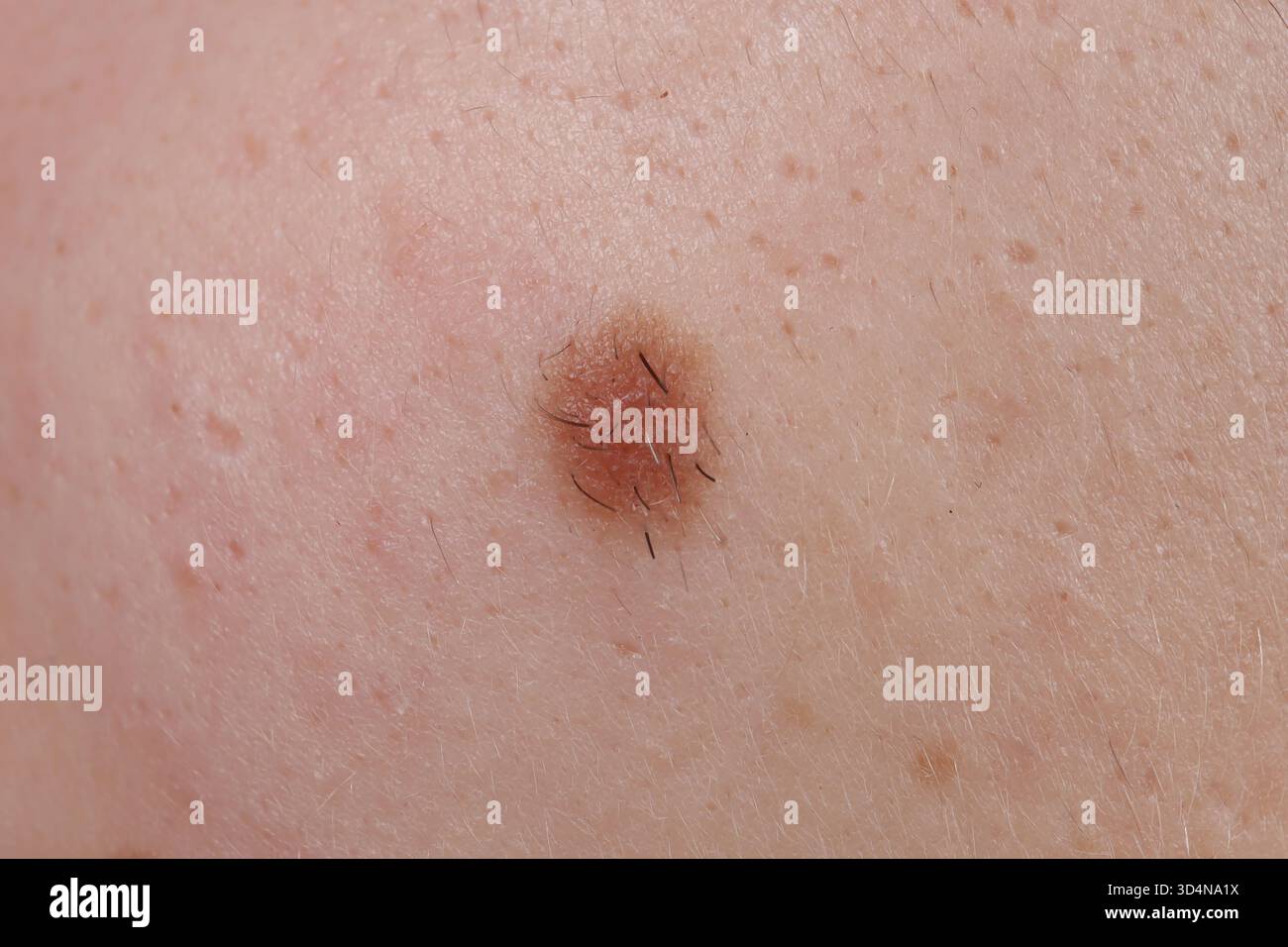Benign dermal nevus of the cheek in a 21-year-old woman Stock Photo - Alamy
