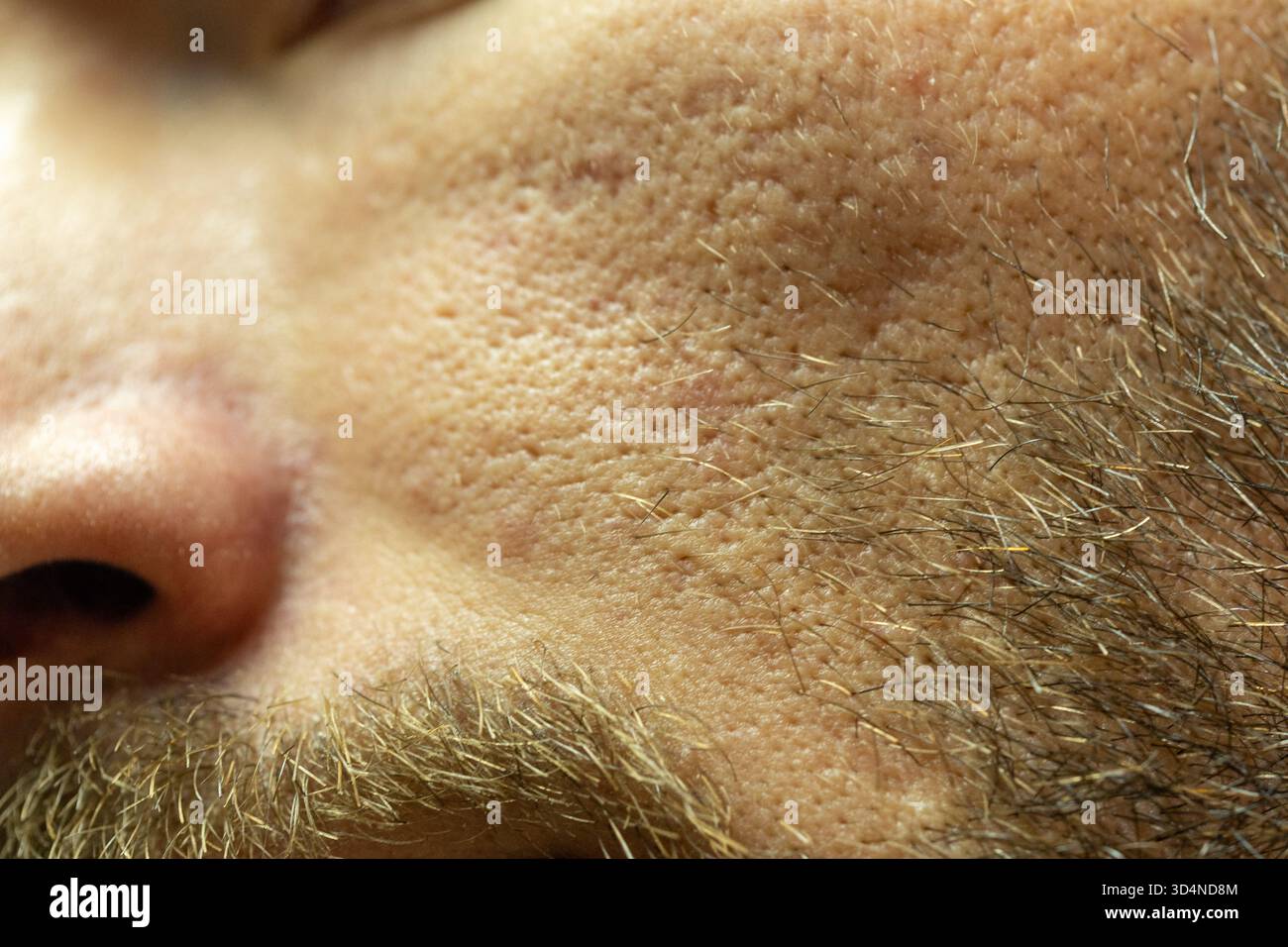 Skin texture showing imperfections hi-res stock photography and images ...