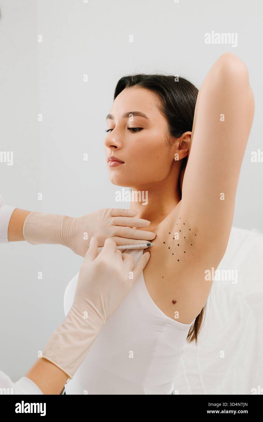 Hyperhidrosis injection for underarm. Intradermal injection procedure ...