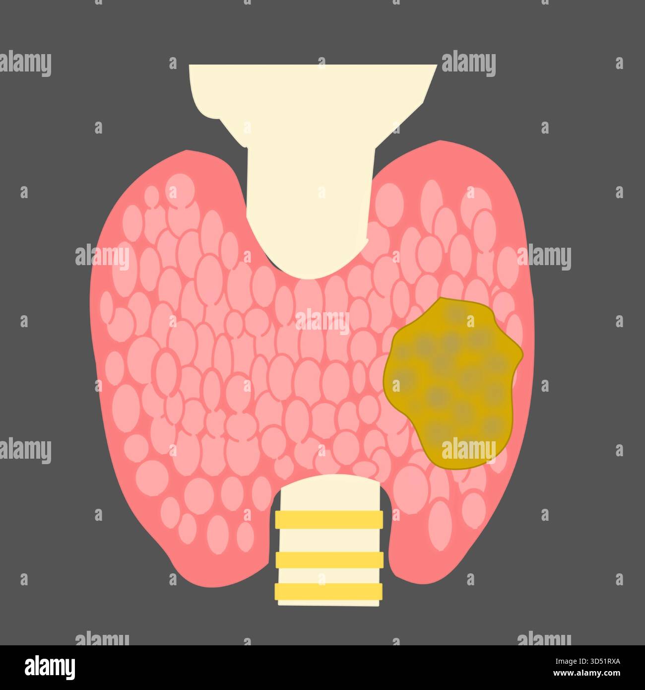 thyroid nodule thyroid cancer medical illustration lymph nodes science ...