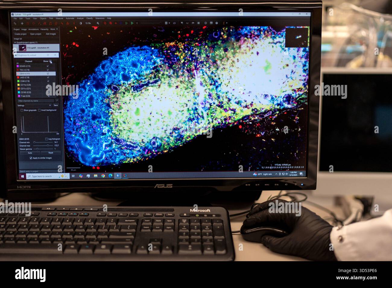 Research fellow Sachin Surwase shows an image of a pancreatic lymph ...