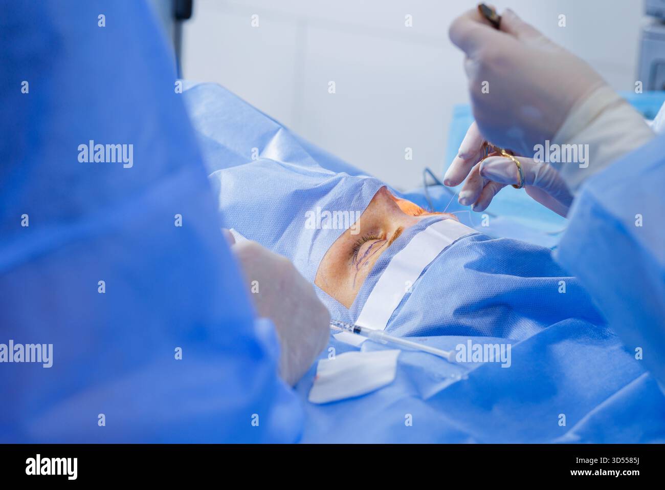 Surgeons suture the upper eyelid during blepharoplasty under local ...