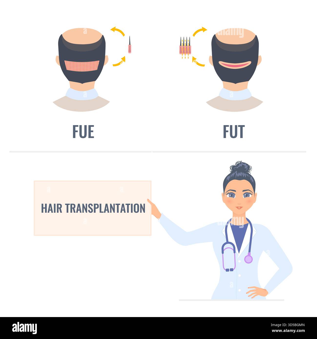 Illustration of hair transplantation. FUE (Follicular Unit Extraction ...