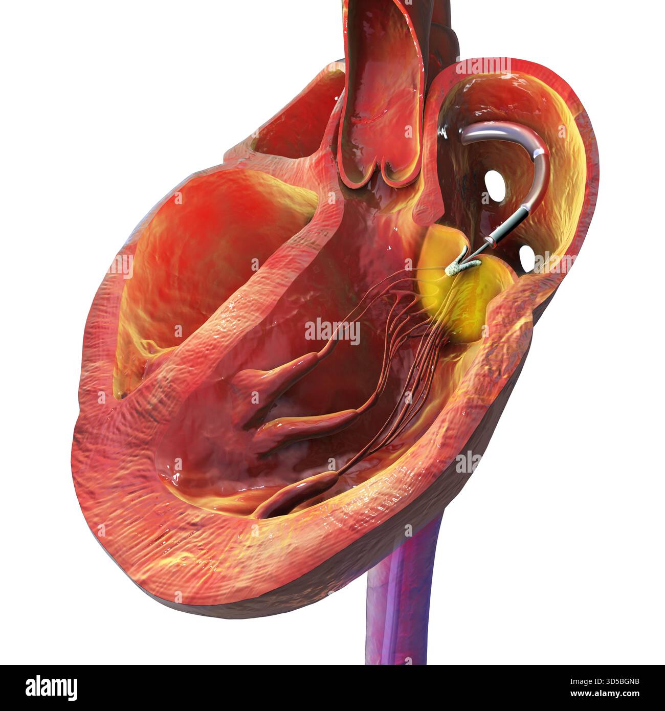 Transcatheter edge to edge repair hi-res stock photography and images ...