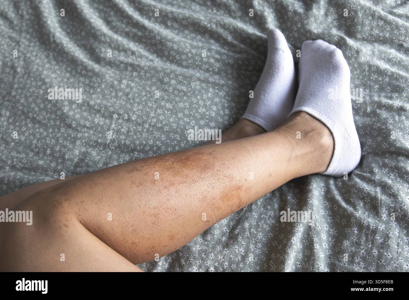 Close-up of a person's legs resting on a bed, with visible birthmarks ...