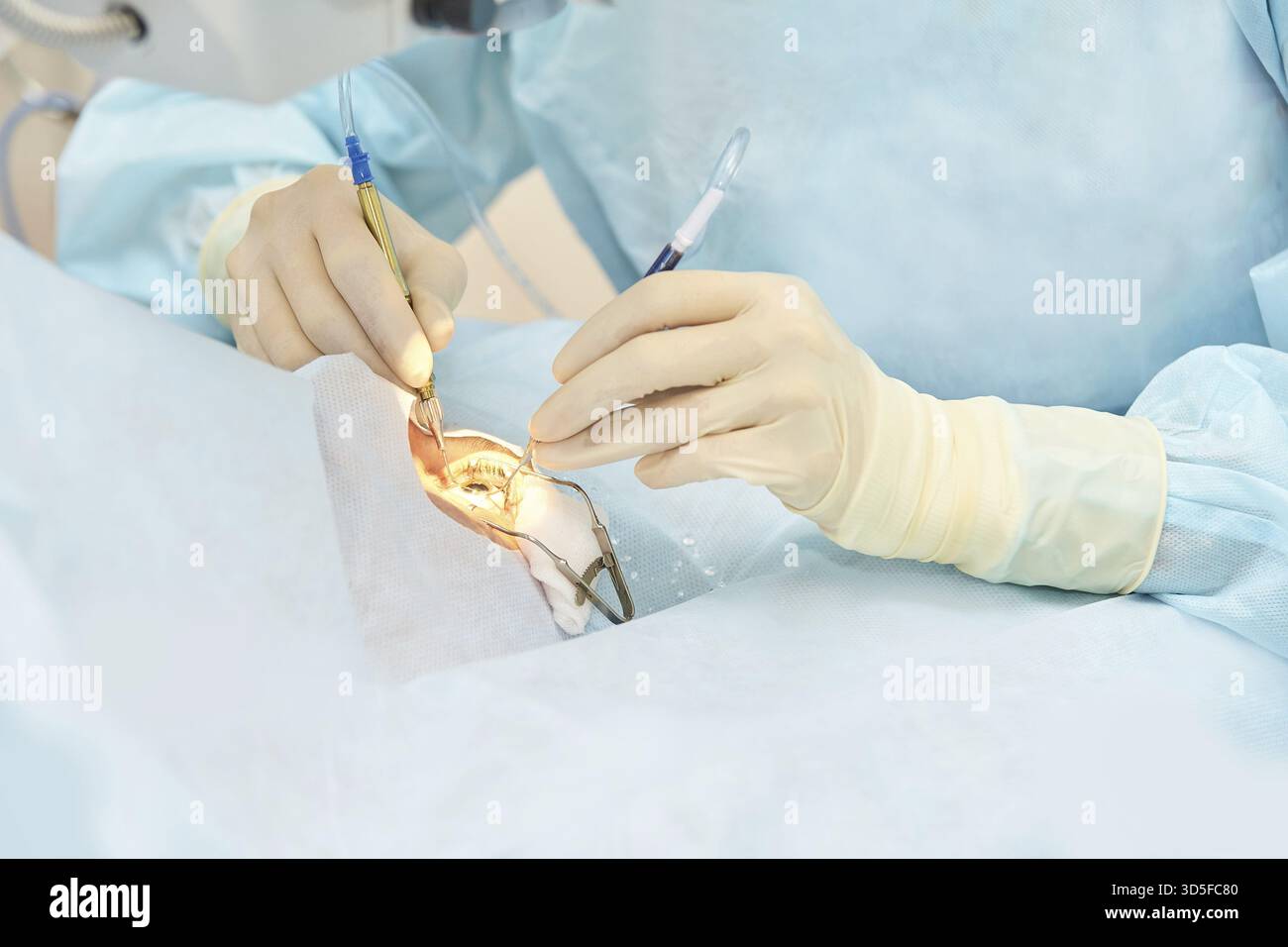 Ophthalmology laser microscope operation. Doctor in clinic. Patient eye ...