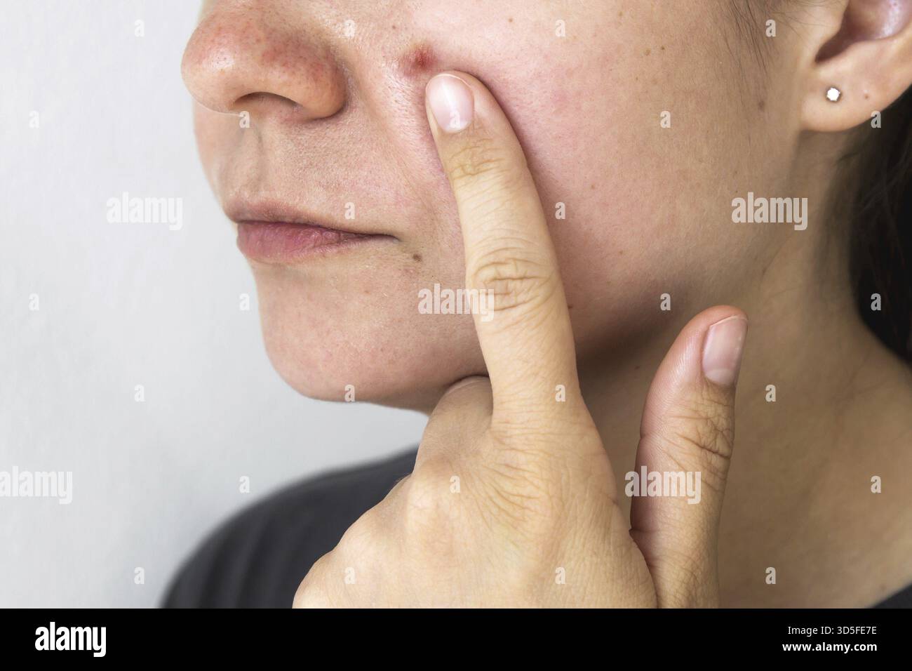 Woman touching inflamed pimple hi-res stock photography and images - Alamy