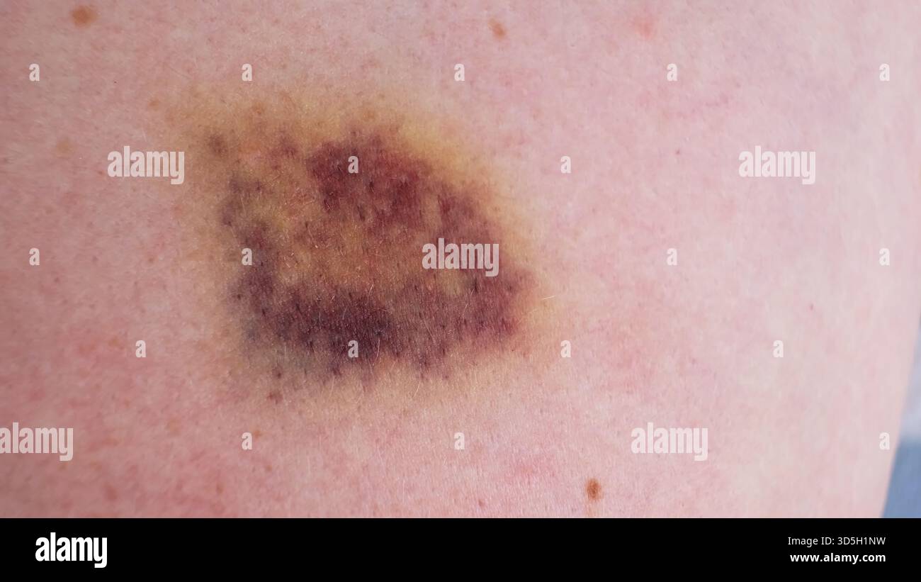 The bruise on skin close-up view. Various shades of healing process ...