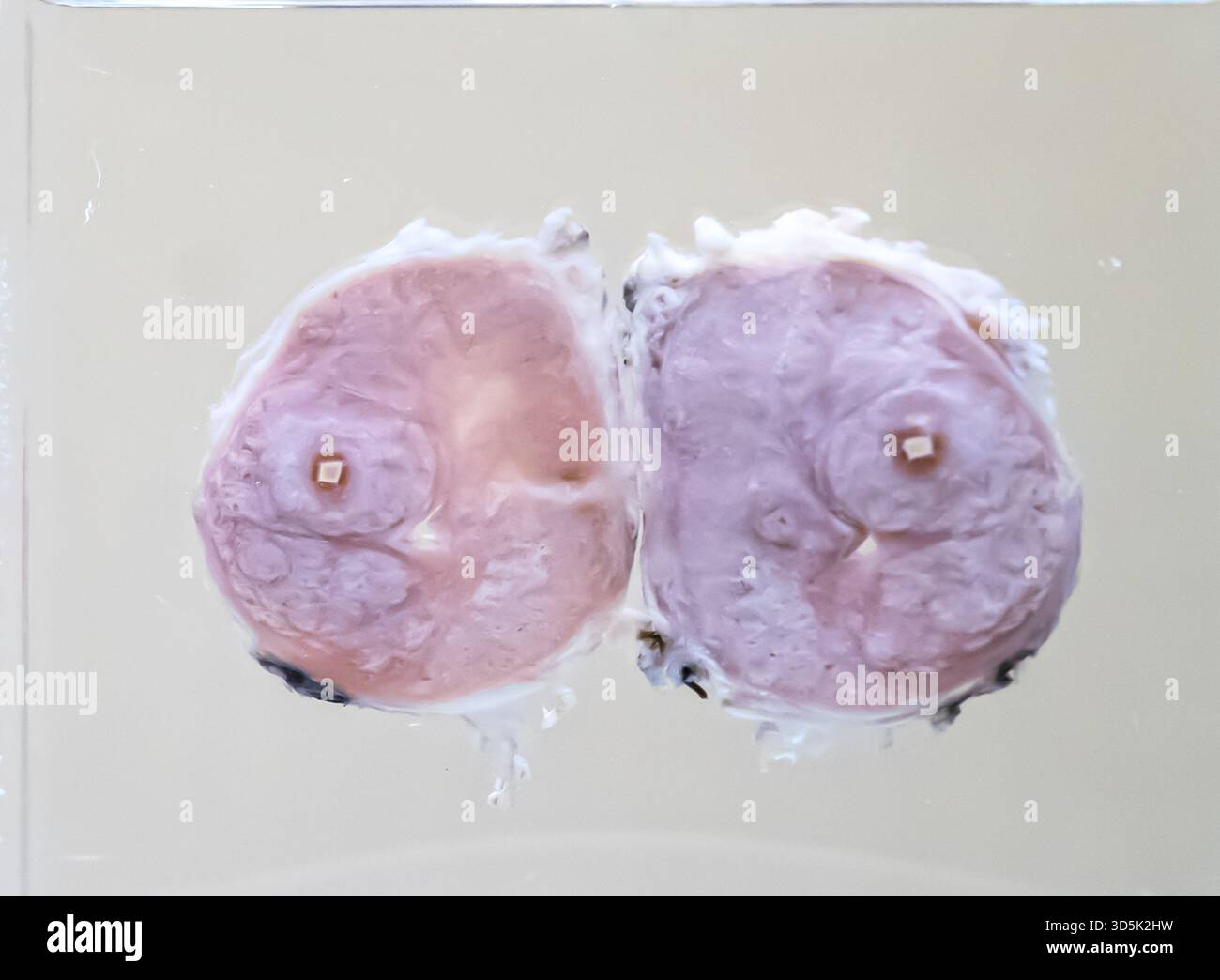 Benign prostatic hyperplasia hi-res stock photography and images - Alamy