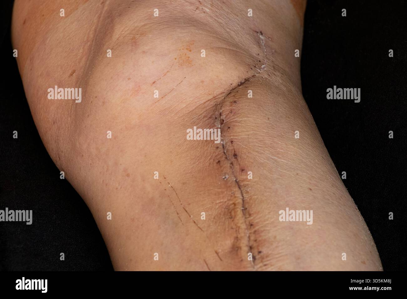 Tibia metal plate hi-res stock photography and images - Alamy