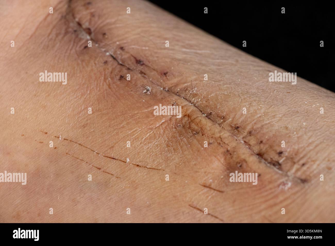 Open fracture hi-res stock photography and images - Alamy