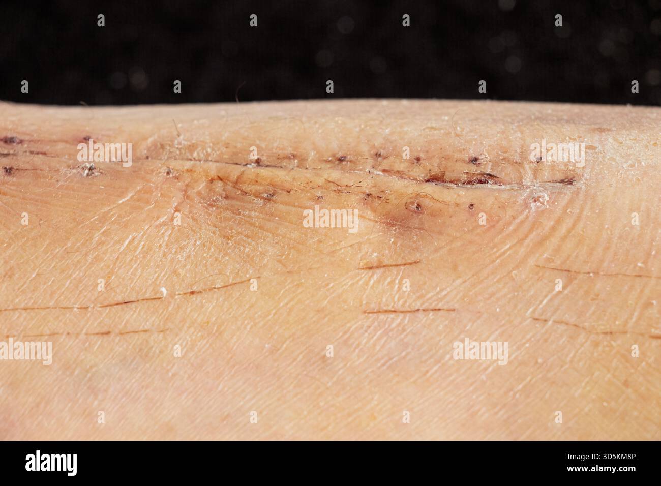 Open reduction of tibia hi-res stock photography and images - Alamy