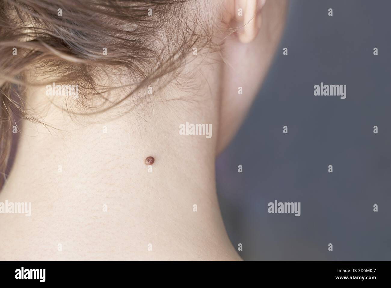 Abnormal mole hi-res stock photography and images - Alamy