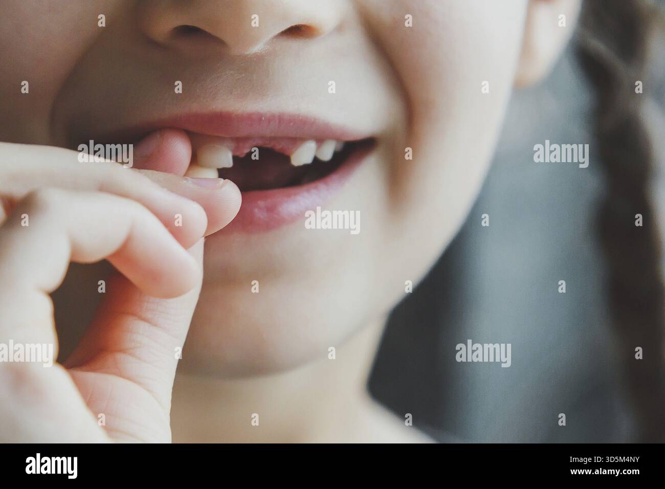 The girl shows her mouth without one milk tooth that has fallen out ...