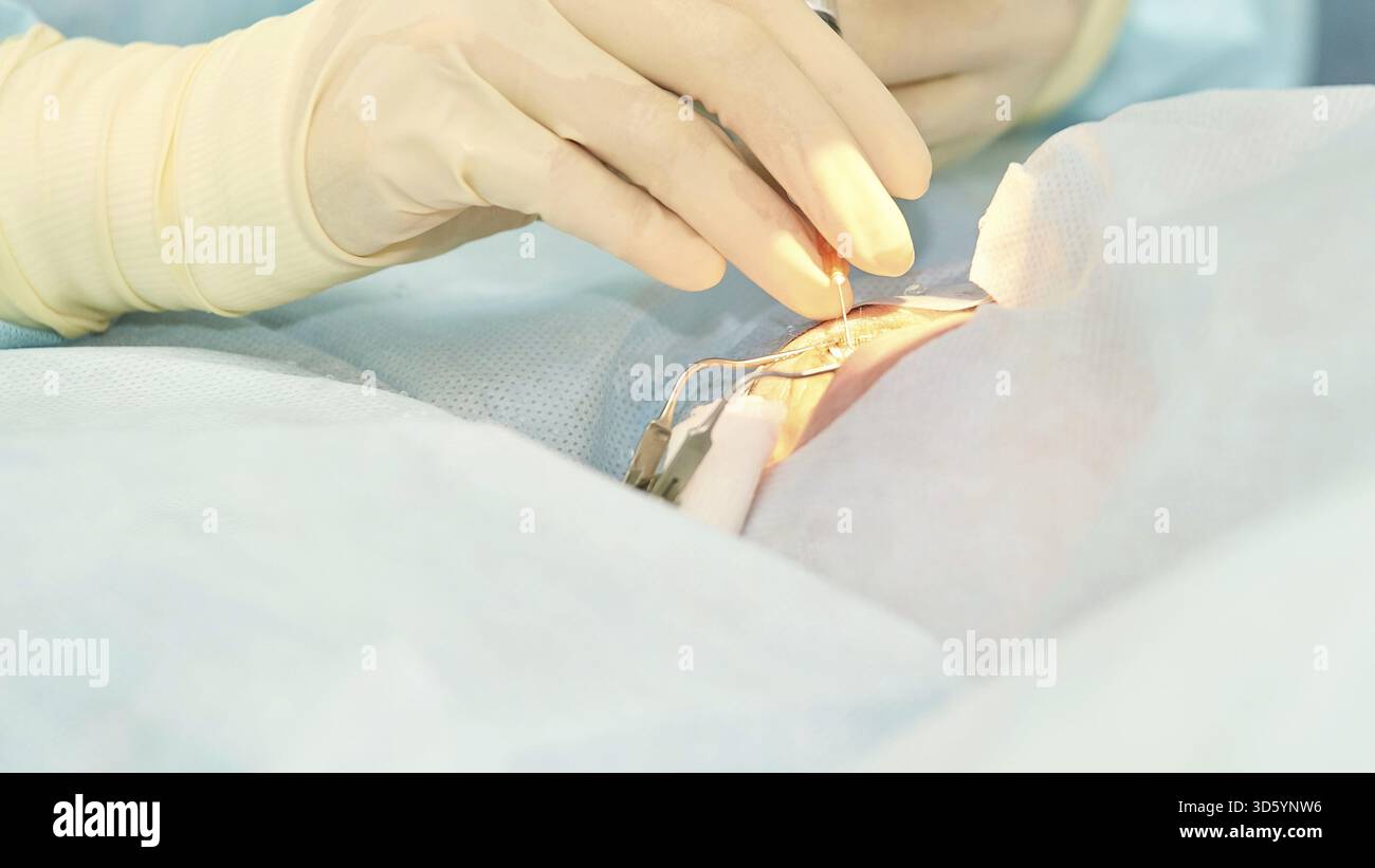 Ophthalmology laser microscope operation. Doctor in clinic. Patient eye ...