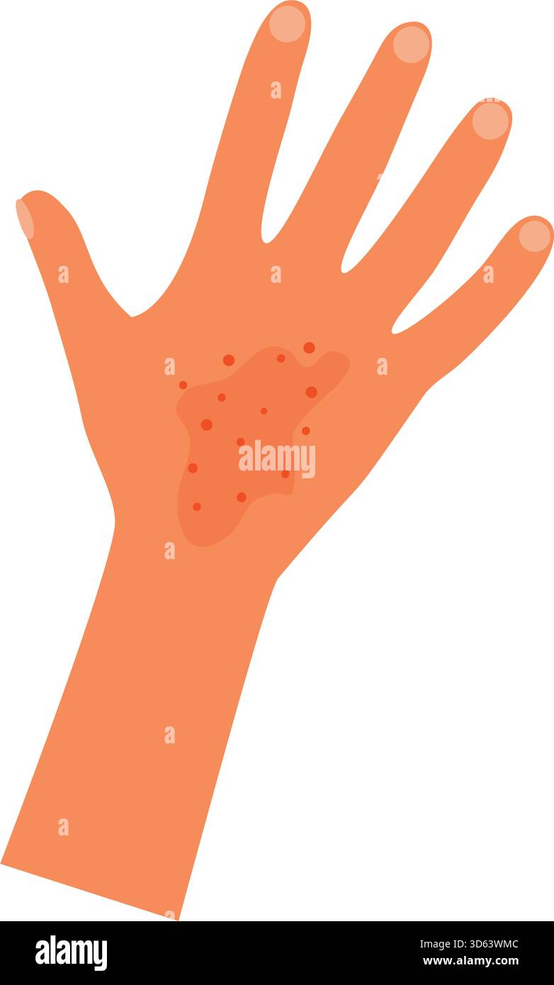 Allergic skin rash on Cut Out Stock Images & Pictures - Alamy