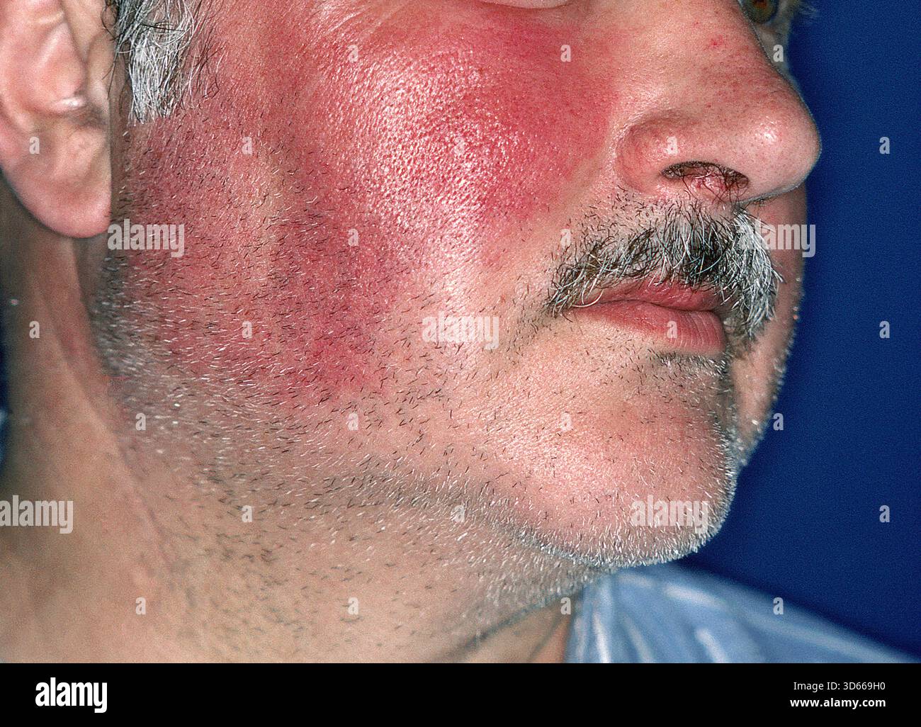 Reddened skin on the face of a male patient with erysipelas. Erysipelas ...