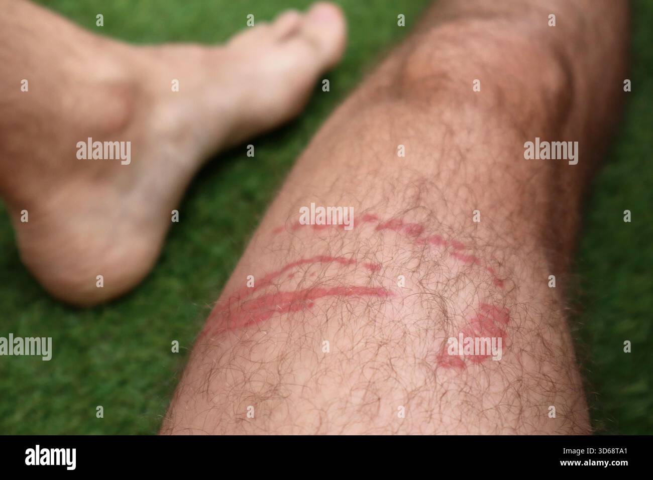 A jellyfish sting burn on a mans leg || Model released Stock Photo - Alamy