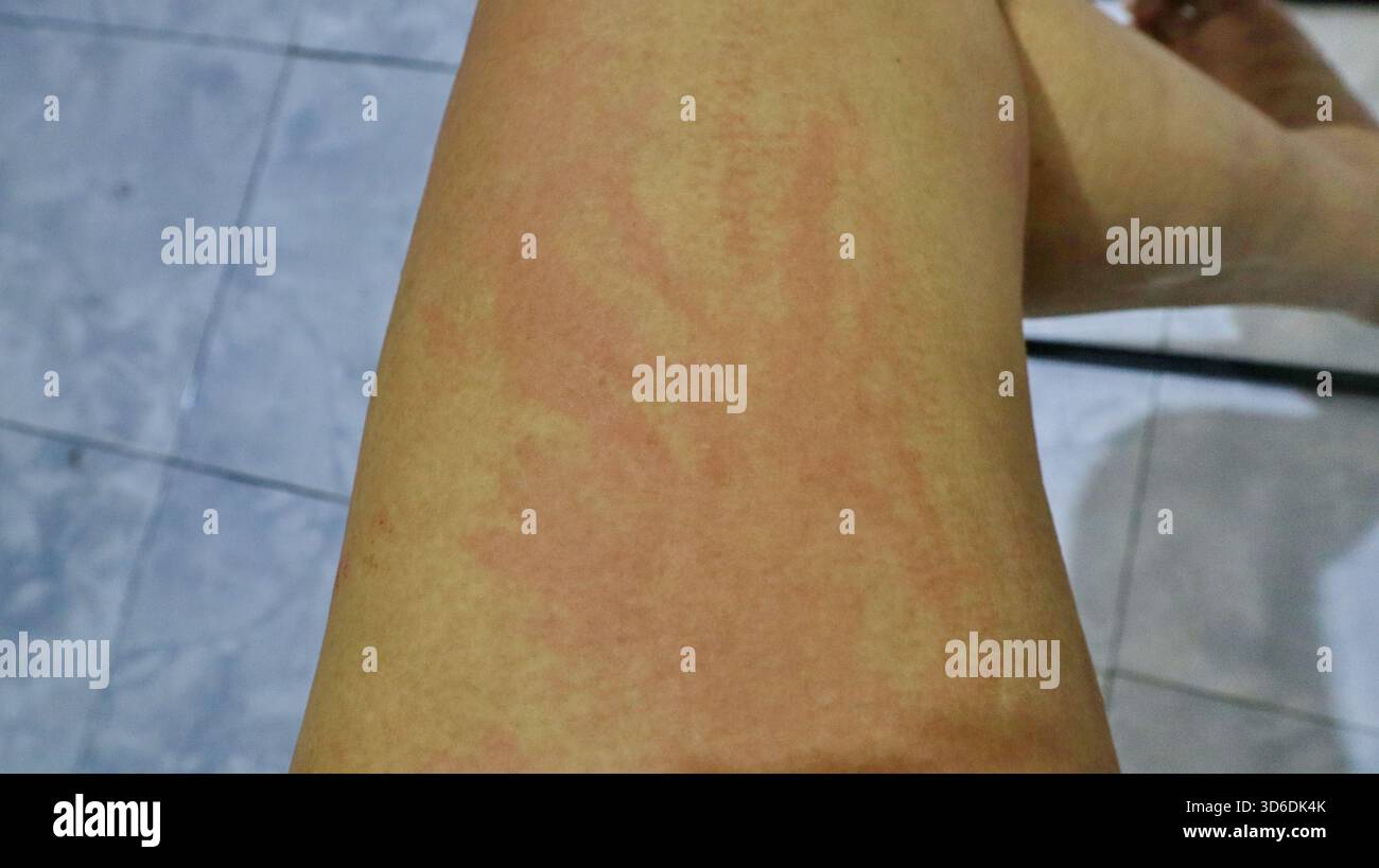 Close up detail of human skin with red rash irritation, possible ...