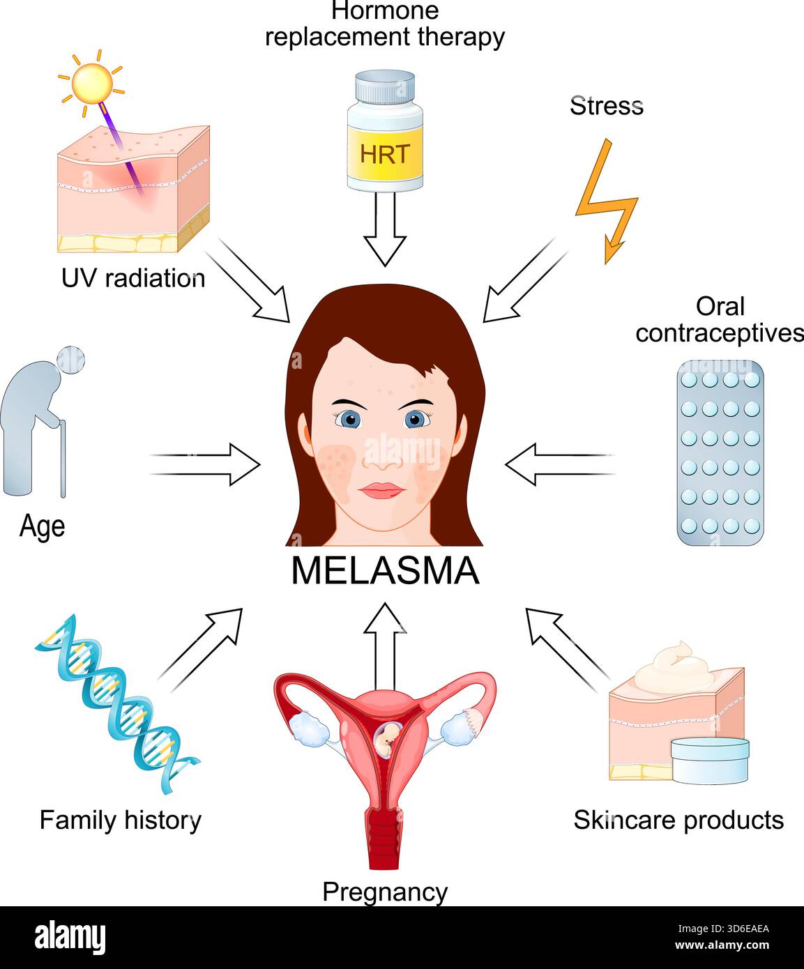 Melasma triggers. Chloasma. Skin hyperpigmentation. Vector illustration ...