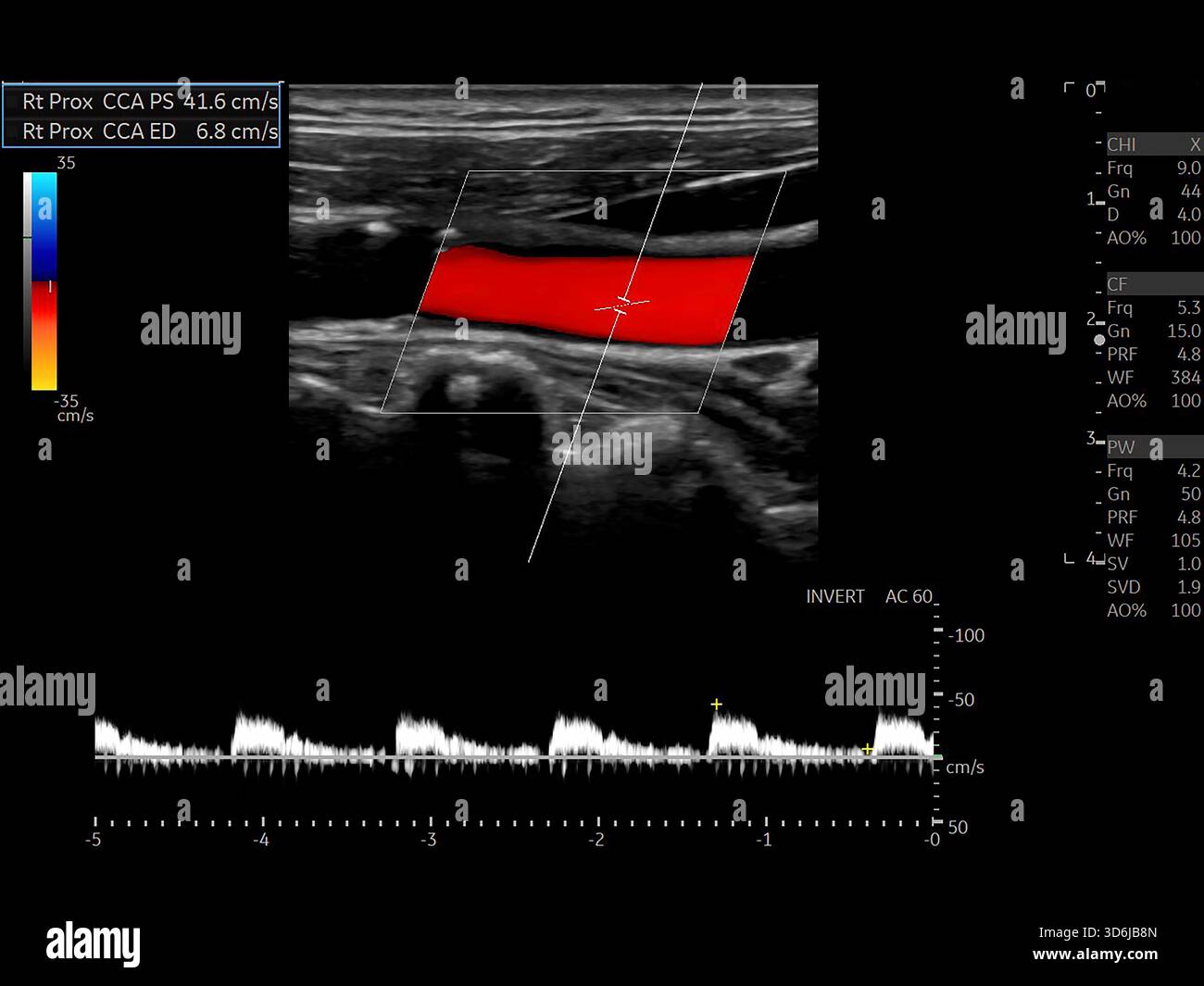 Detailed Color Doppler ultrasound study of the carotid artery showing ...