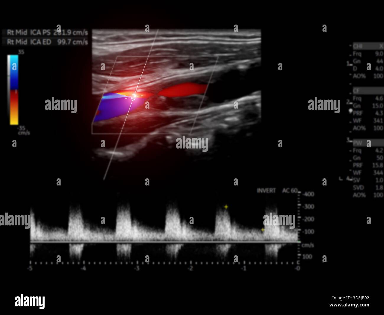 Abnormal common carotid artery hi-res stock photography and images - Alamy