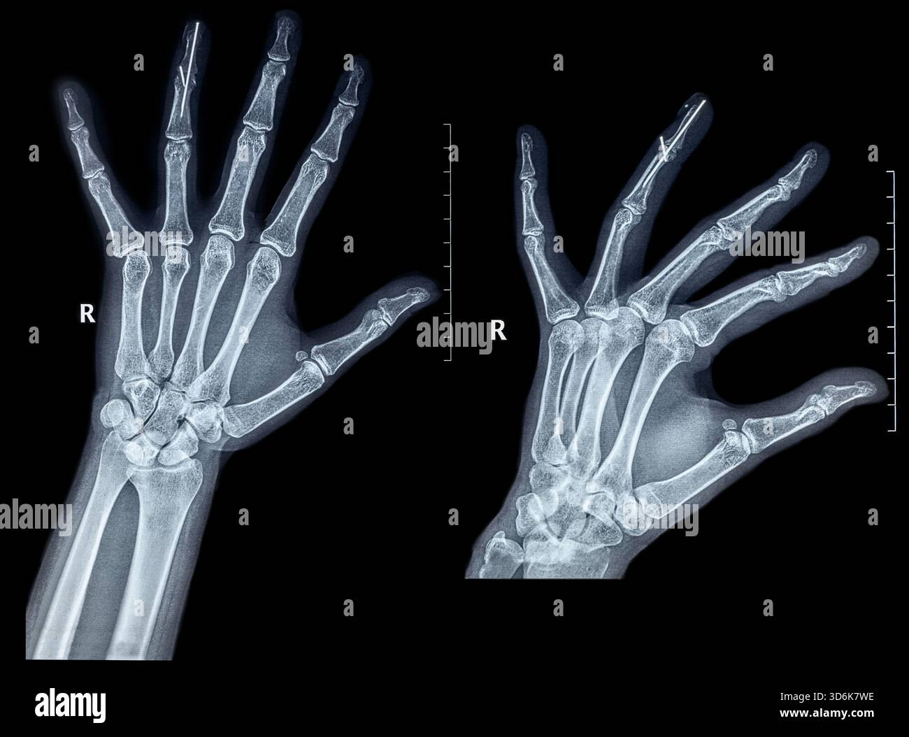 Post operative x-ray distal interphalangeal joint fusion arthrodesis of ...