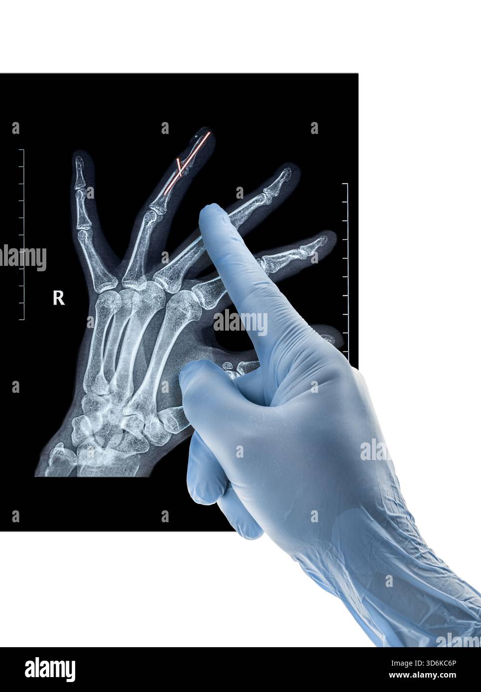 Post operative x-ray distal interphalangeal joint fusion arthrodesis of ...