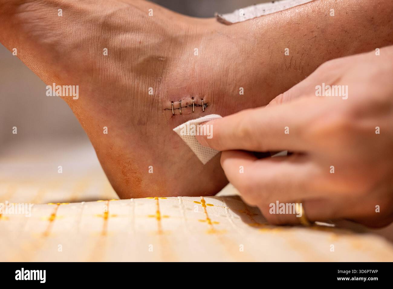 Post-operative wound care with surgical staples on ankle. A hand is ...