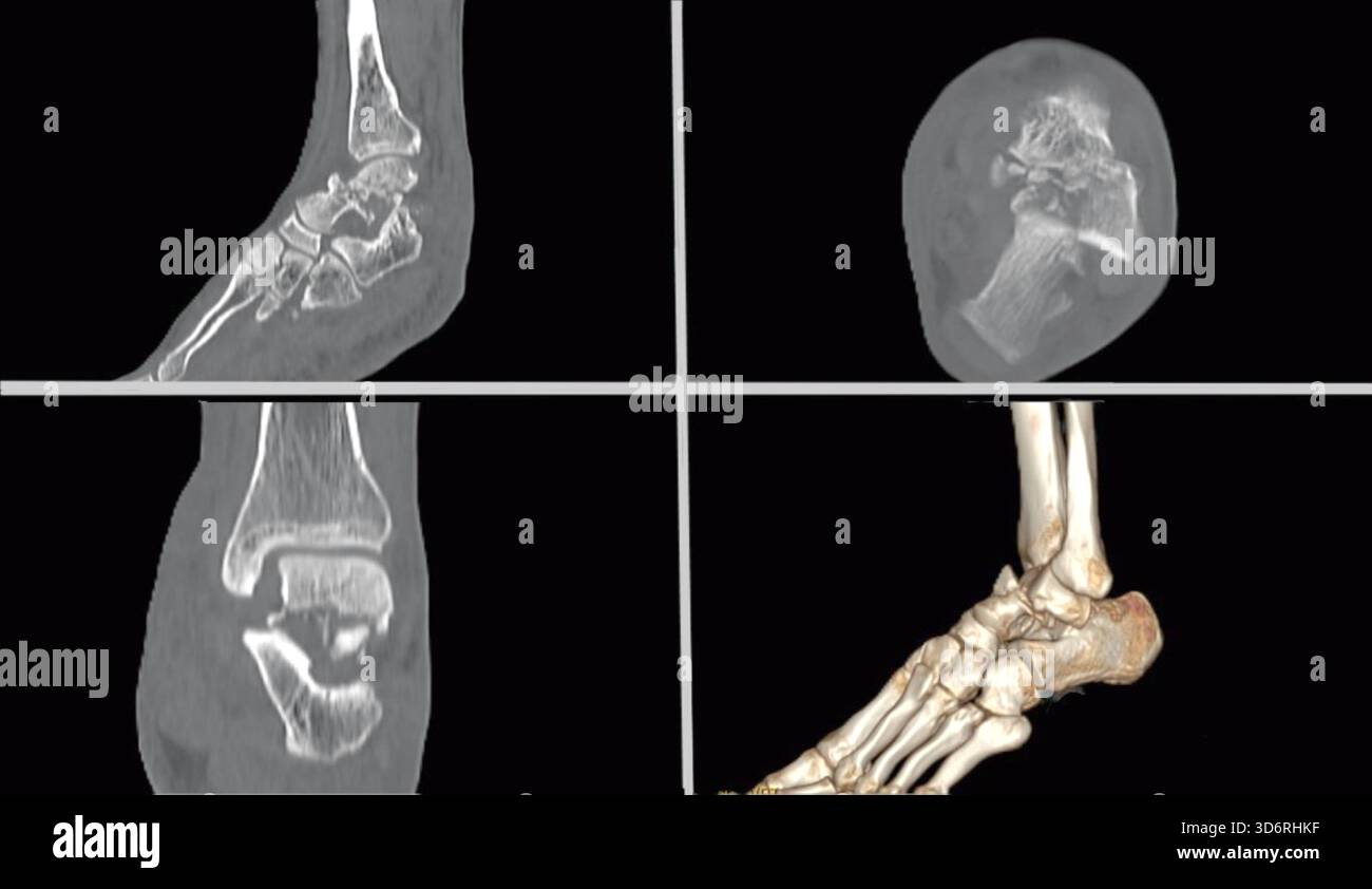 Computed tomography (CT) scans of an ankle fracture of the talus bone ...