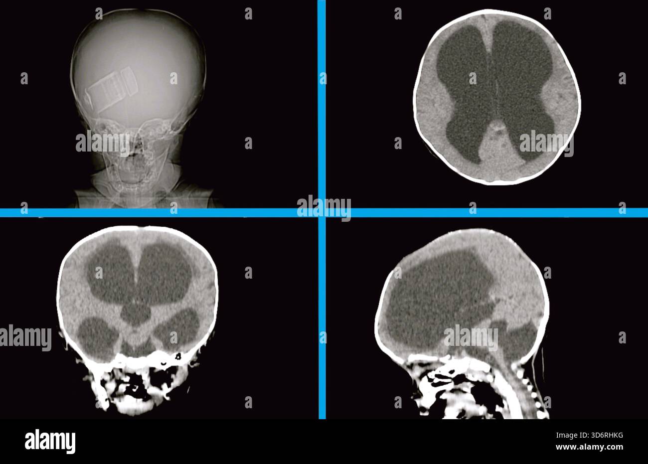 Computed tomography (CT) scan of the brain of a child with ...