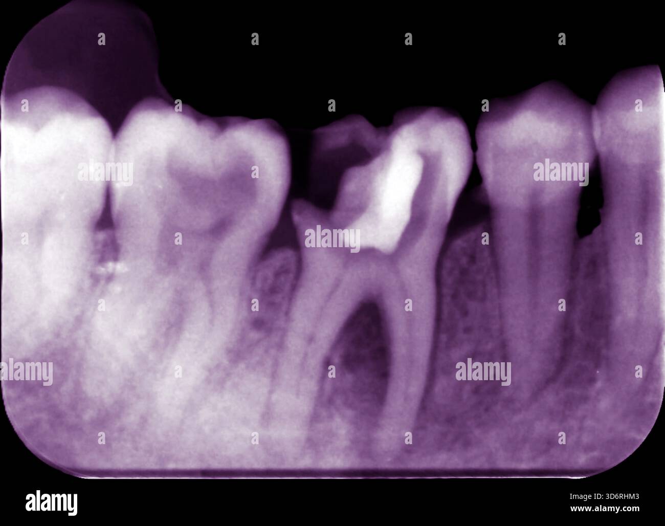 Tooth infected with cavities hi-res stock photography and images - Alamy