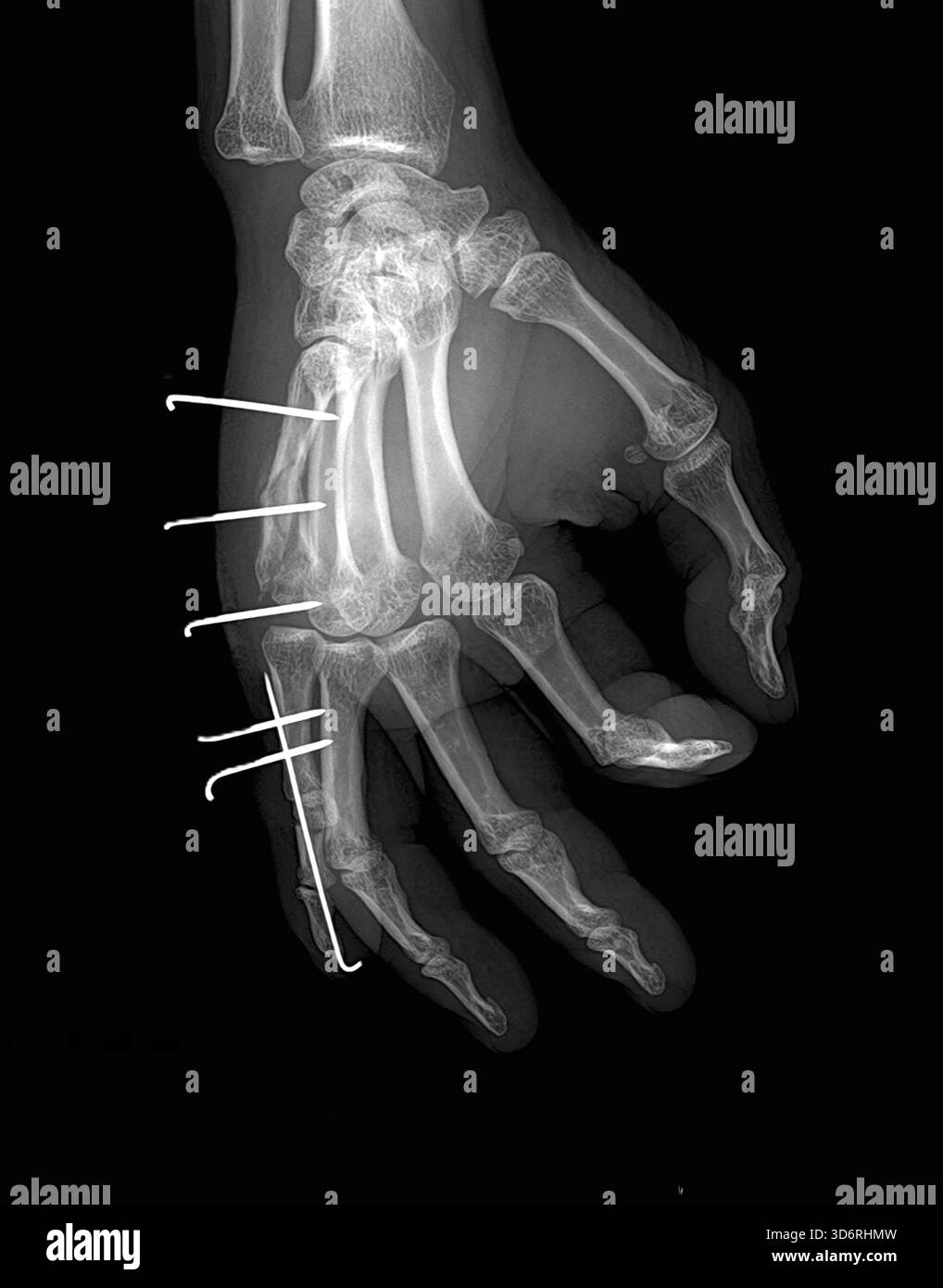 X-ray of a fractured hand that has been internally fixed. The fixation ...