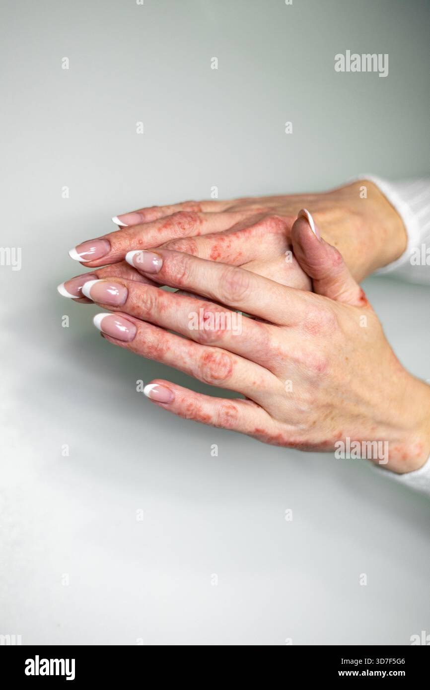 Hands show visible signs of inflammation and irritation caused by ...