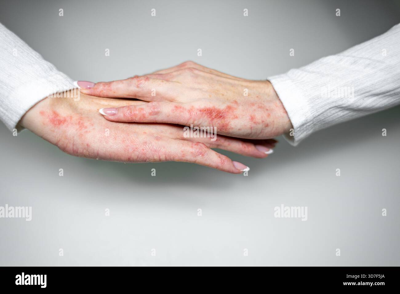 Hands with visible eczema and skin irritation show signs of contact ...