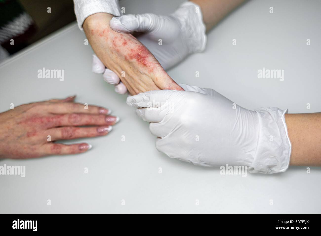 A healthcare professional examines a patient's hand with skin issues ...