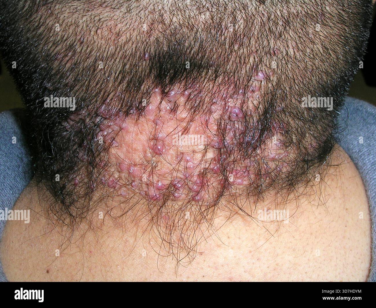 Acne keloidalis nuchae (AKN) on the back of a patient's neck. AKN is a ...