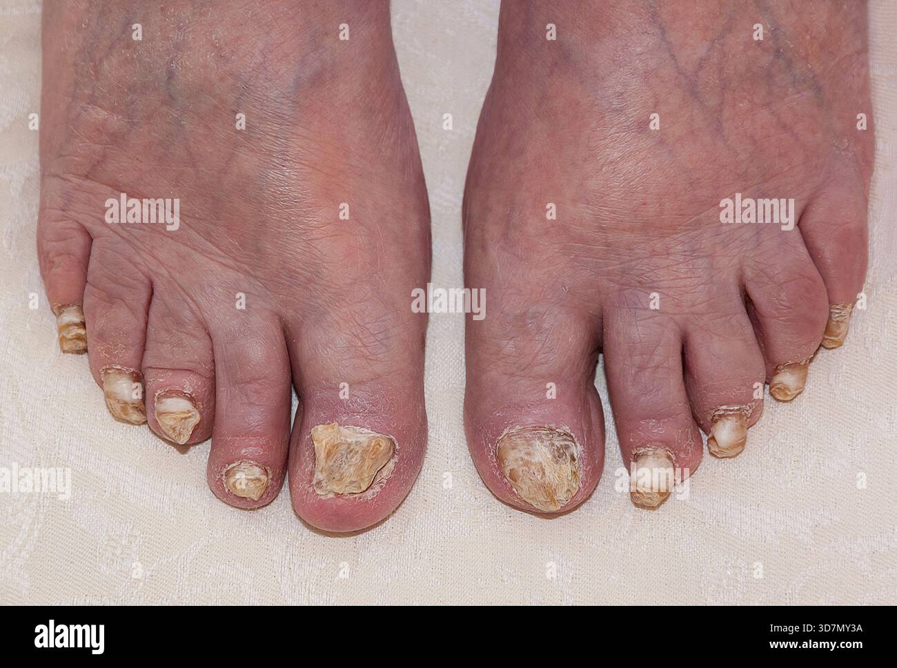 Toenail fungus infection (chychomycosis) that causes discolored, thick ...