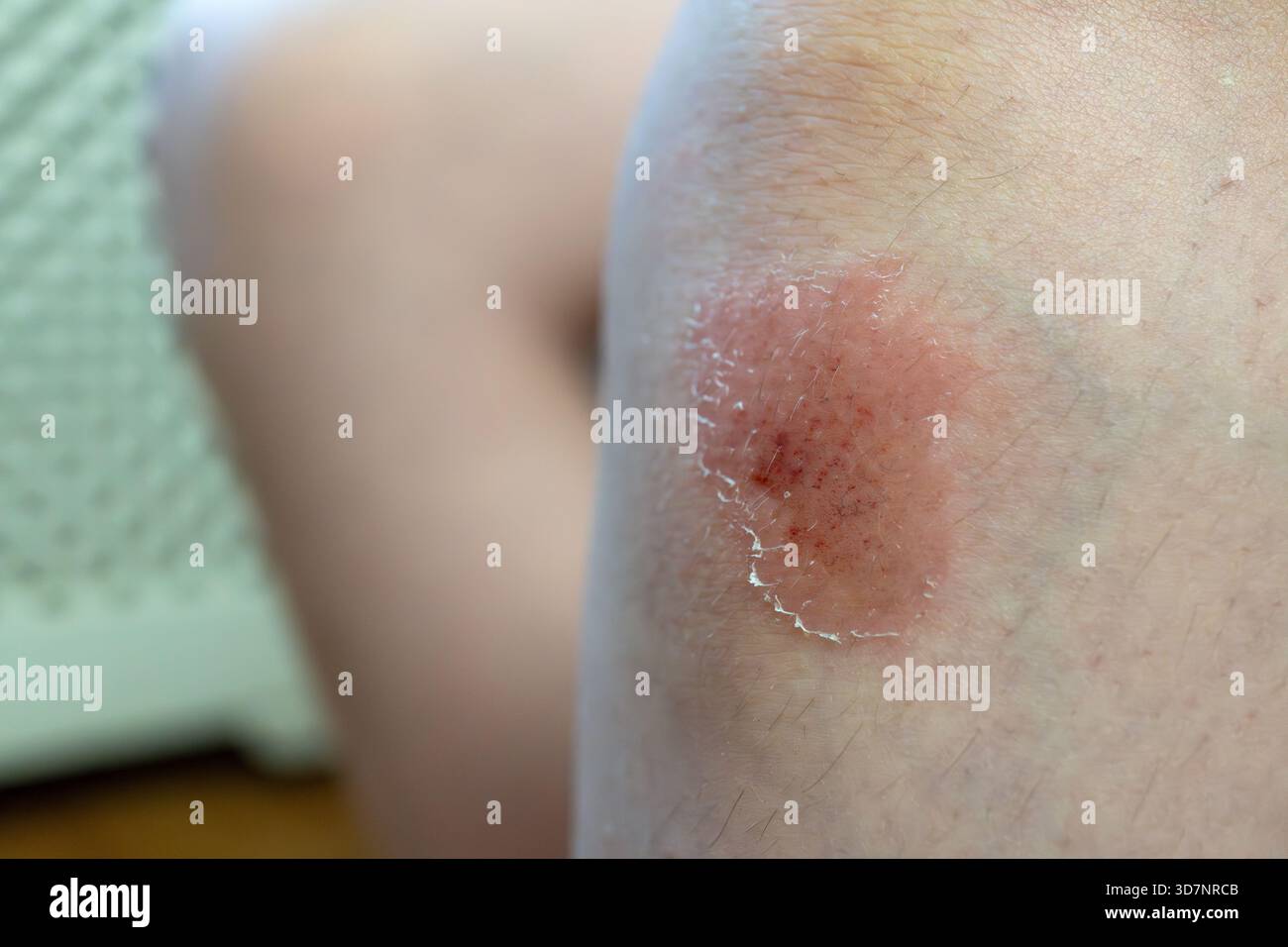Skin abrasion hi-res stock photography and images - Alamy