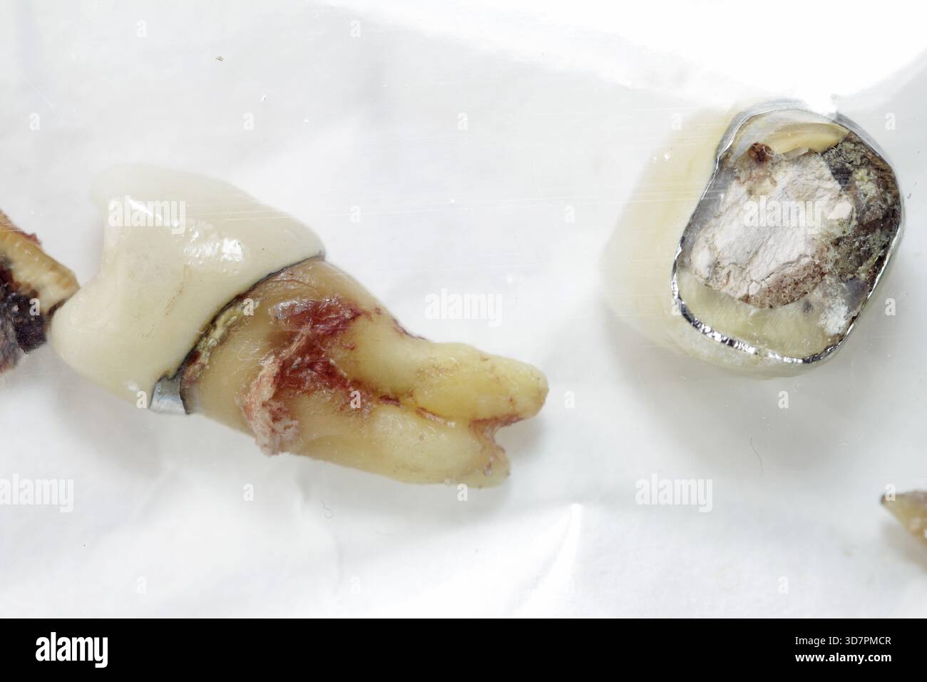 Close-up of extracted teeth with metal fillings and root. Horn-Bad ...