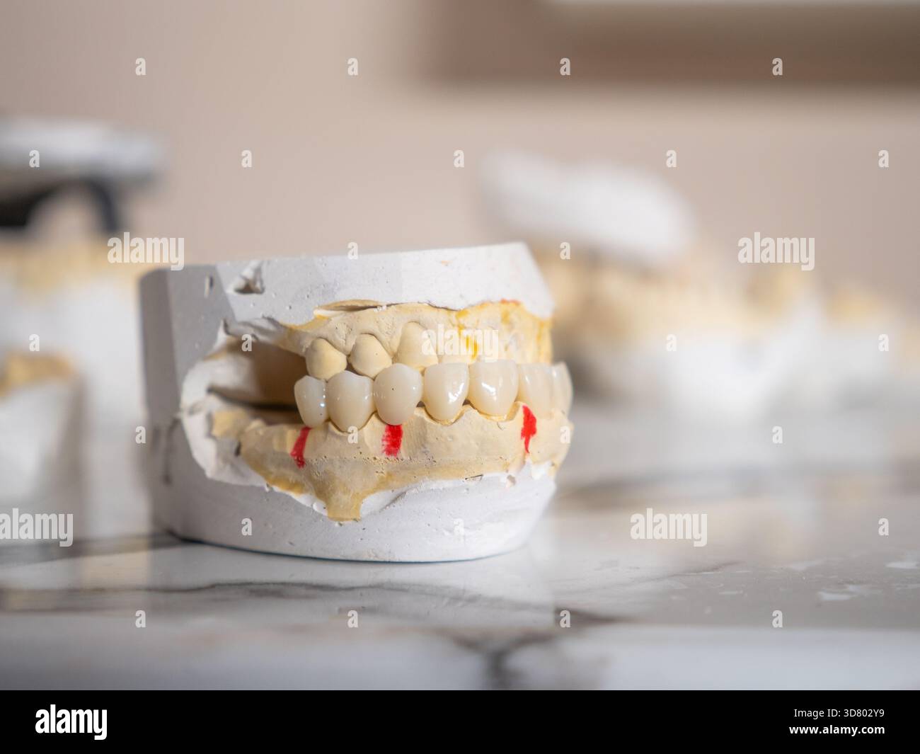 Dental lab prosthetic model with ceramic crowns used in crown ...