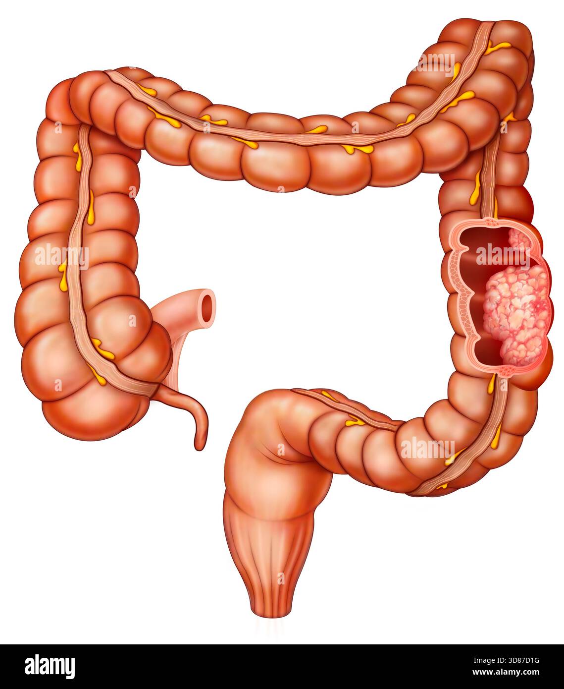 Illustration of the colon affected by a cancerous tumour. This is a ...